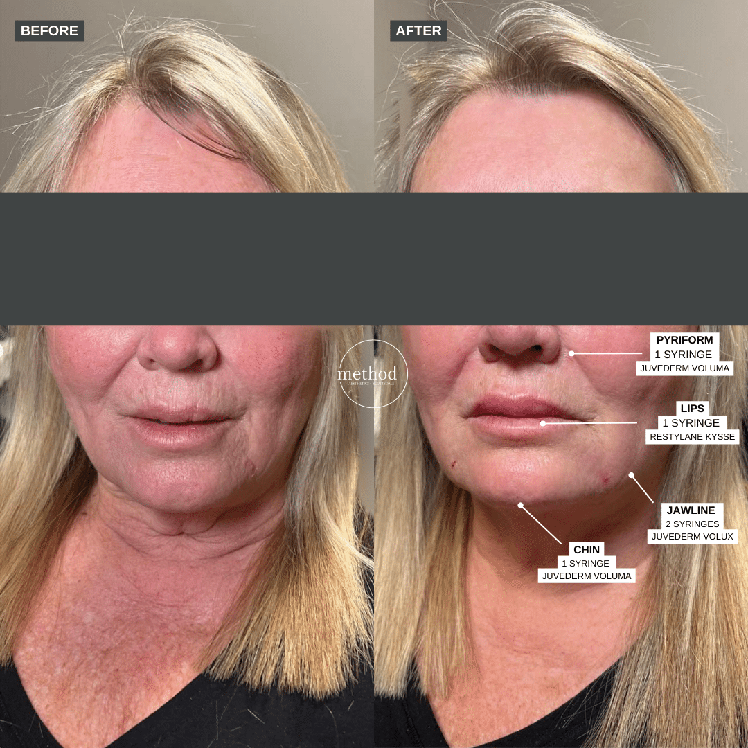 Dermal Fillers North Scottsdale Injectables Paradise Valley